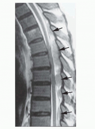 Neoplasms of the Spine | Radiology Key
