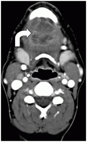 Head and Neck Infections | Radiology Key