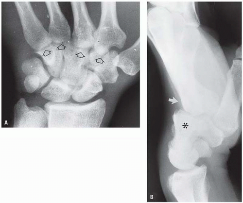 Wrist | Radiology Key