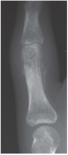 Hand | Radiology Key