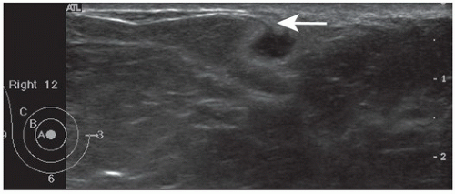 Breast Imaging | Radiology Key