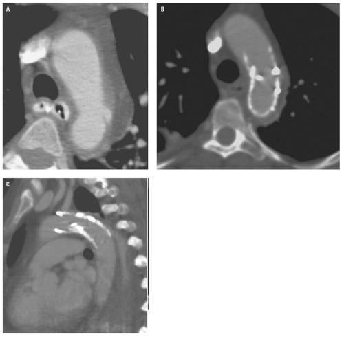 Chest: Trauma | Radiology Key