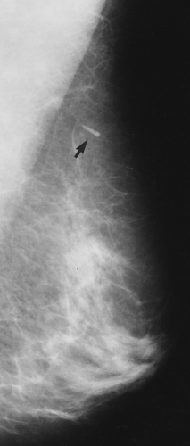 Benign Lesions | Radiology Key