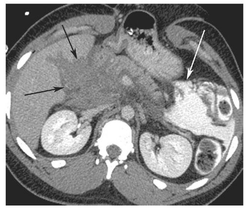 Abdomen: Traumatic Emergencies | Radiology Key