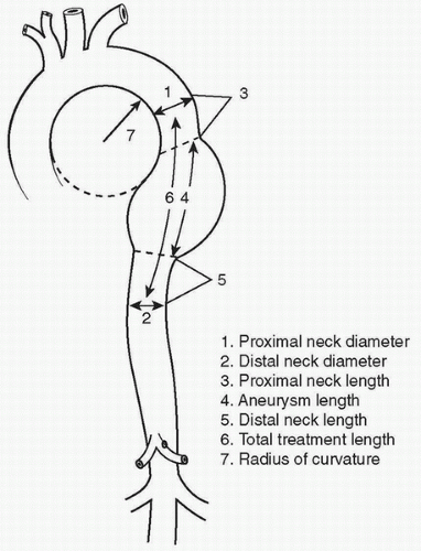 Thoracic Aortic Aneurysms and Dissections | Radiology Key