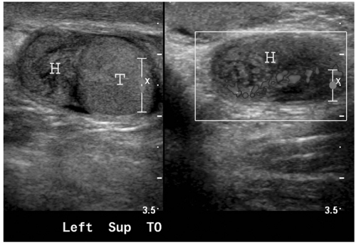Gynecologic, Obstetric, and Scrotal Emergencies | Radiology Key