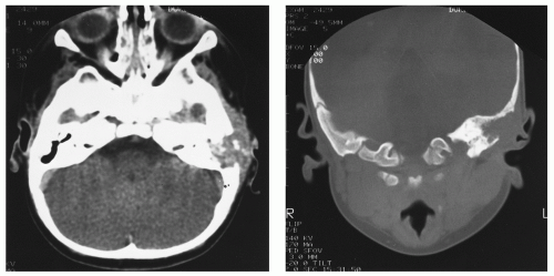 Langerhans Cell Histiocytosis | Radiology Key