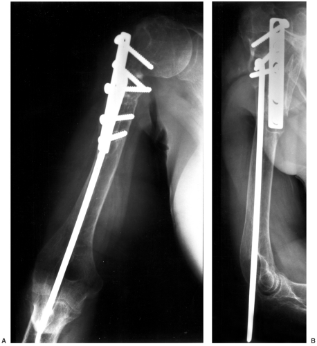 Common Orthopaedic Terminology and General Fixation Devices | Radiology Key