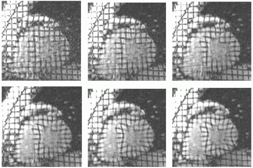 Cardiac Tagging | Radiology Key