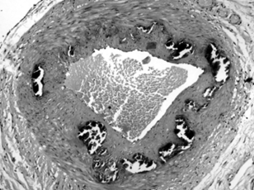A Pathologist’s Overview of the Pathology of Breast Disease | Radiology Key