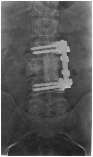 Spinal Instrumentation | Radiology Key
