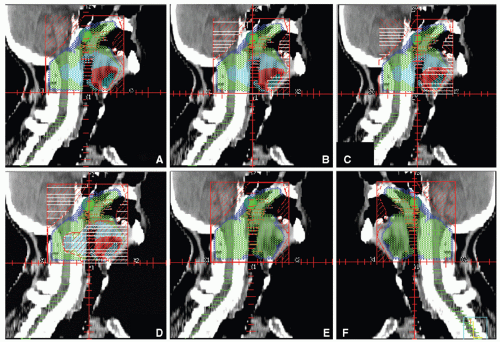 Practical Aspects of External Beam Therapy | Radiology Key