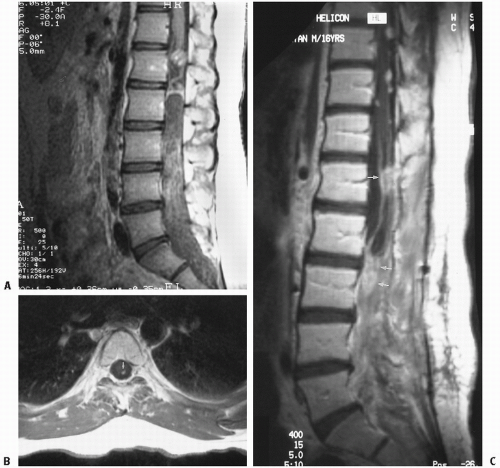 Tumors of the Posterior Fossa and the Spinal Canal | Radiology Key