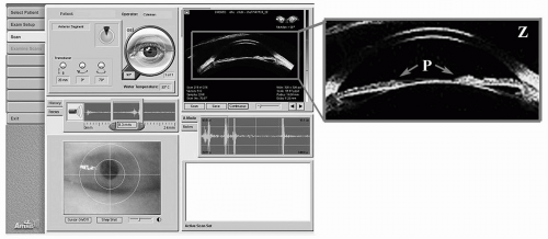 Very High Frequency Digital Ultrasound Scanning in LASIK and Phakic ...
