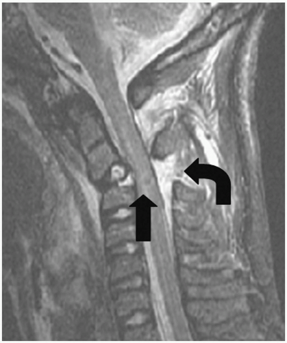 Cervical Spine Trauma | Radiology Key