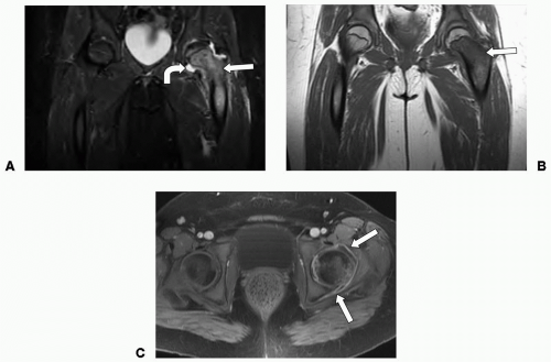 Septic Arthritis | Radiology Key