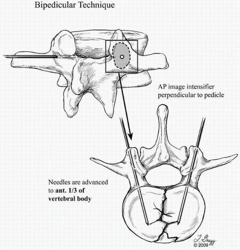 Vertebroplasty and Kyphoplasty | Radiology Key