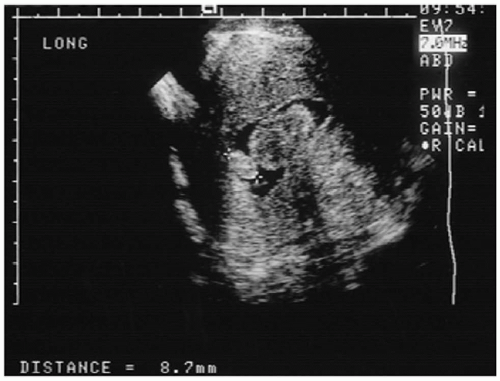 Saline Infusion Sonohysterography | Radiology Key
