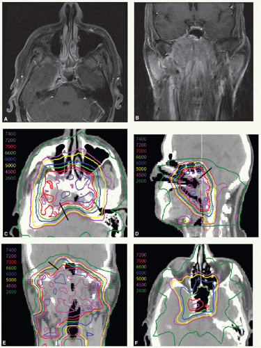 Nasopharynx | Radiology Key