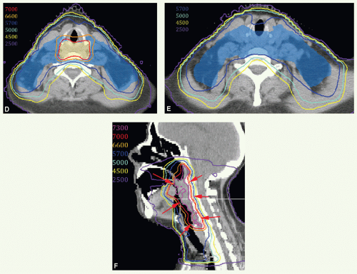 Oropharynx | Radiology Key