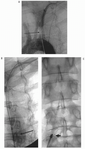 Retrieval of Intravascular Foreign Bodies | Radiology Key