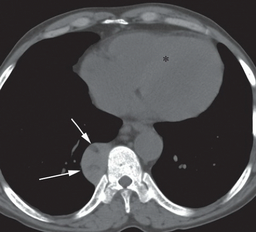 Thoracic Radiology | Radiology Key