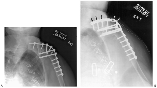 The Shoulder | Radiology Key