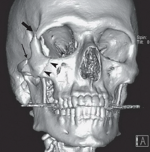 Frontozygomatic Suture
