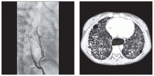 Esophageal Scleroderma | Radiology Key