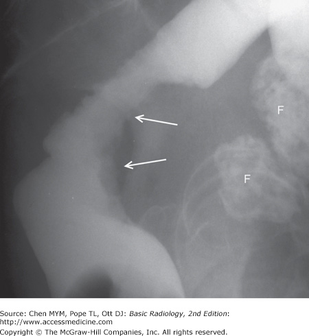 Chapter 10. Gastrointestinal Tract | Radiology Key