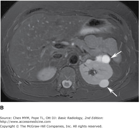 Chapter 11. Liver, Biliary Tract, and Pancreas | Radiology Key