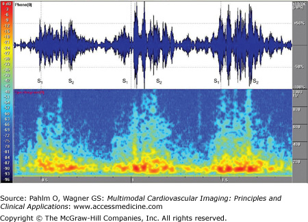 Phonocardiography | Radiology Key