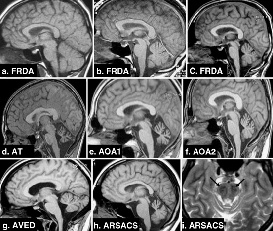 Ataxia Telangiectasia Mri