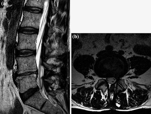 Recurrent Herniated Lumbar Disk Patient Reoperated | Radiology Key