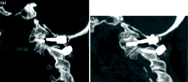 Degenerative Cervical Instability Stabilization–Posterior Decompression ...