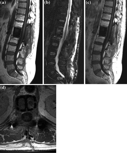 Lumbar Collapse in Chordoma Vertebral Drawing | Radiology Key