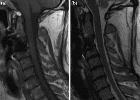 Neoplastic Cervical Dislocation-Collapse Vertebral Removal | Radiology Key