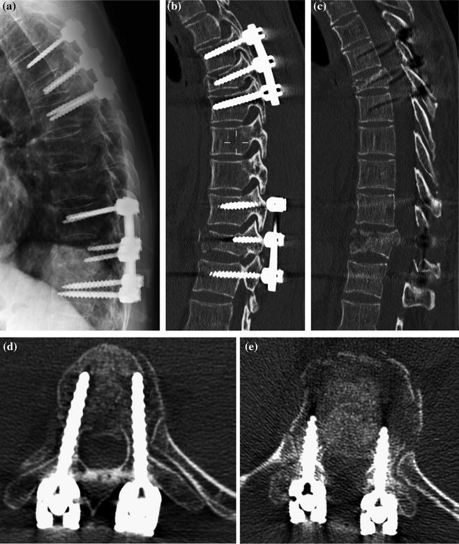 Multiple Traumatic Dorsal Collapses Double Stabilization | Radiology Key