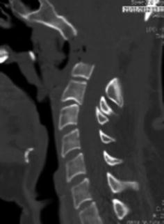 Atlanto-Occipital Malformation Anterior Odontoid Drawing | Radiology Key