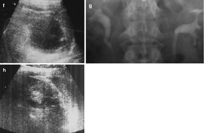 Diagnostics of Pelvicalyceal Diverticula | Radiology Key