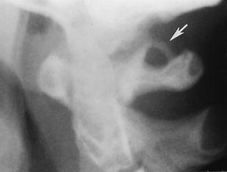 Normal Variations | Radiology Key