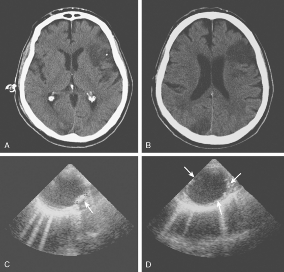 Subarachnoid Hemorrhage | Radiology Key