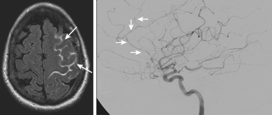 Subarachnoid Hemorrhage | Radiology Key