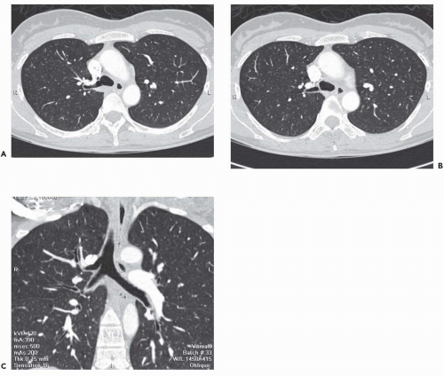 Bronchiectasis | Radiology Key