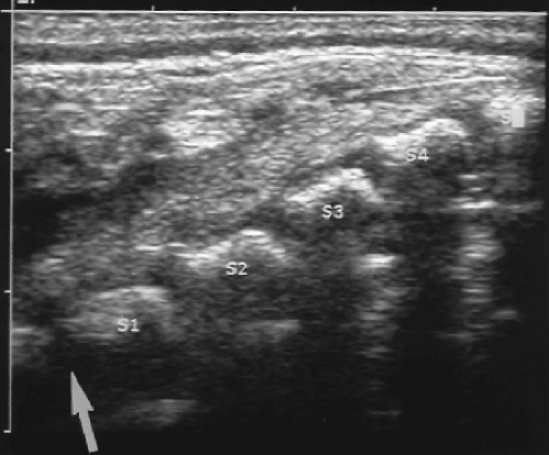 Neonatal Neurosonography | Radiology Key