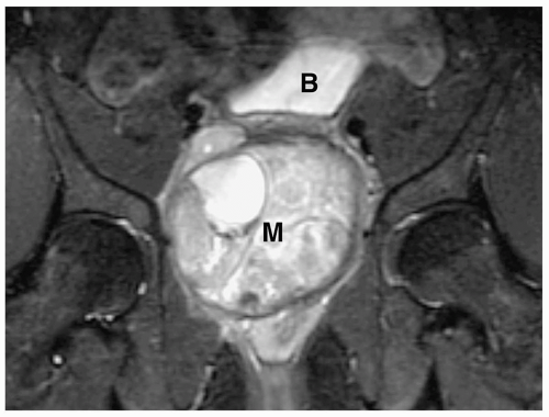 Male Genital Tract | Radiology Key