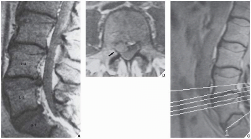 Spine | Radiology Key