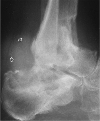 Musculoskeletal Infection | Radiology Key
