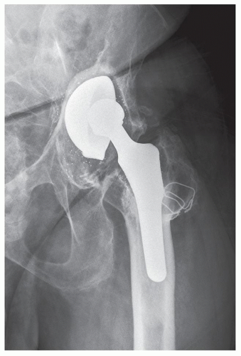 Radiologic Evaluation of the Arthritides | Radiology Key