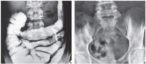 Inflammatory Arthritides | Radiology Key